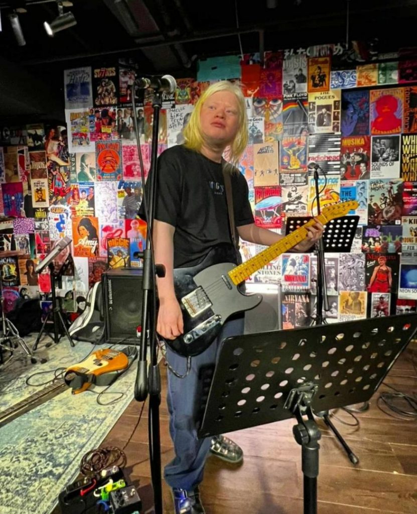 From Outcast To Indie Singer-Songwriter: The Albino Musician ...